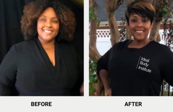 Endoscopic Sleeve Gastroplasty Before and After: ESG Results