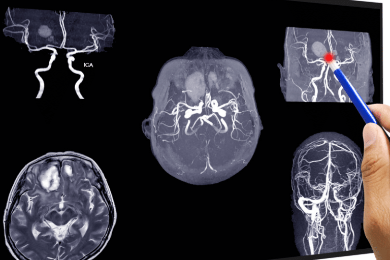 Peripheral Venous Disease PVD vs. Peripheral Artery Disease PAD