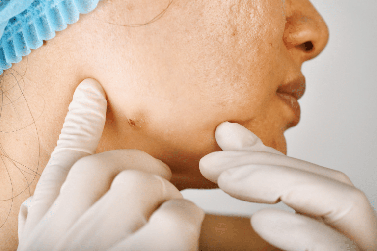 Cystic Cysts | Causes, Signs, Symptoms, Diagnoses, Treatments